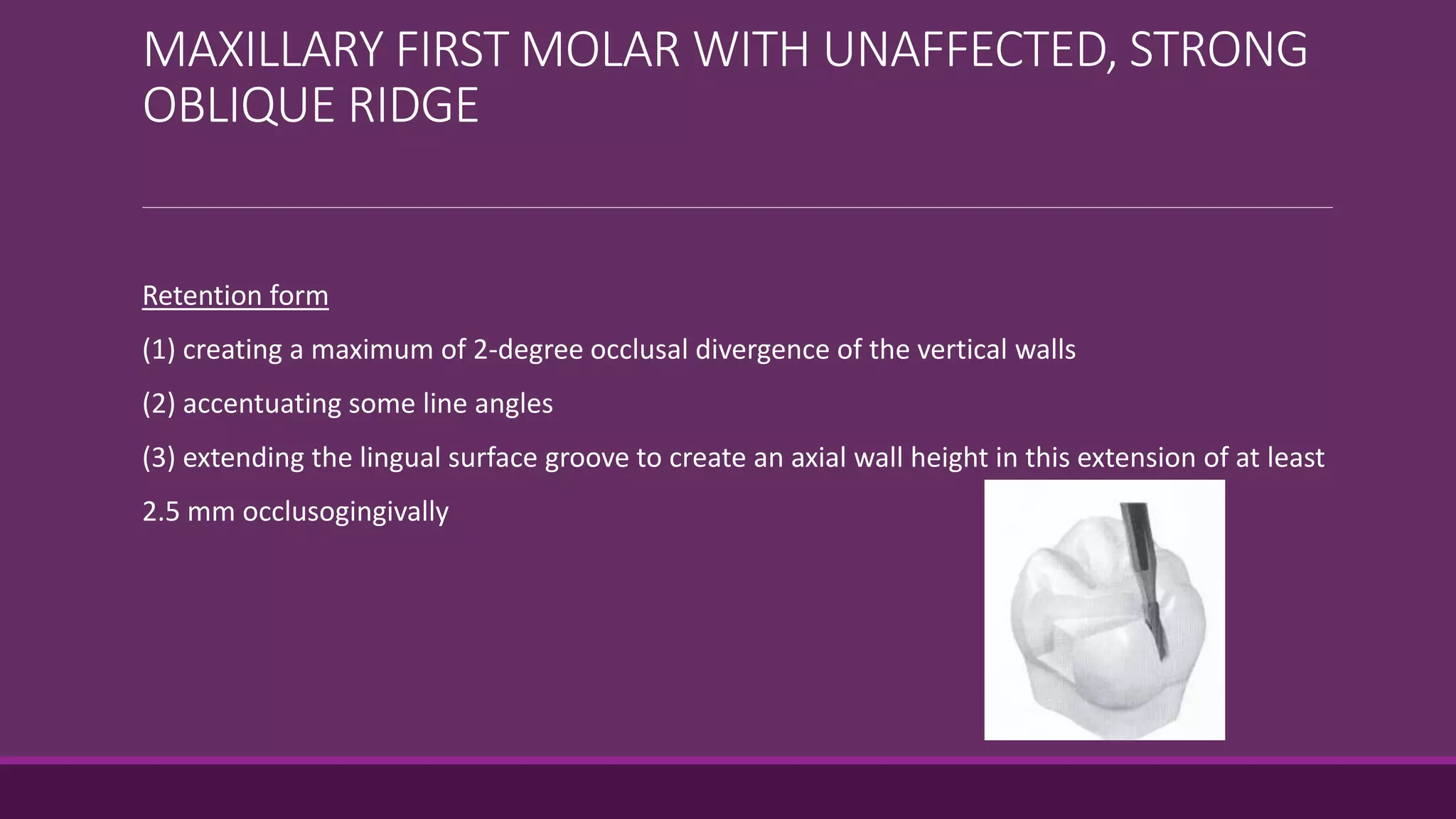 Class II Inlay | PPTX