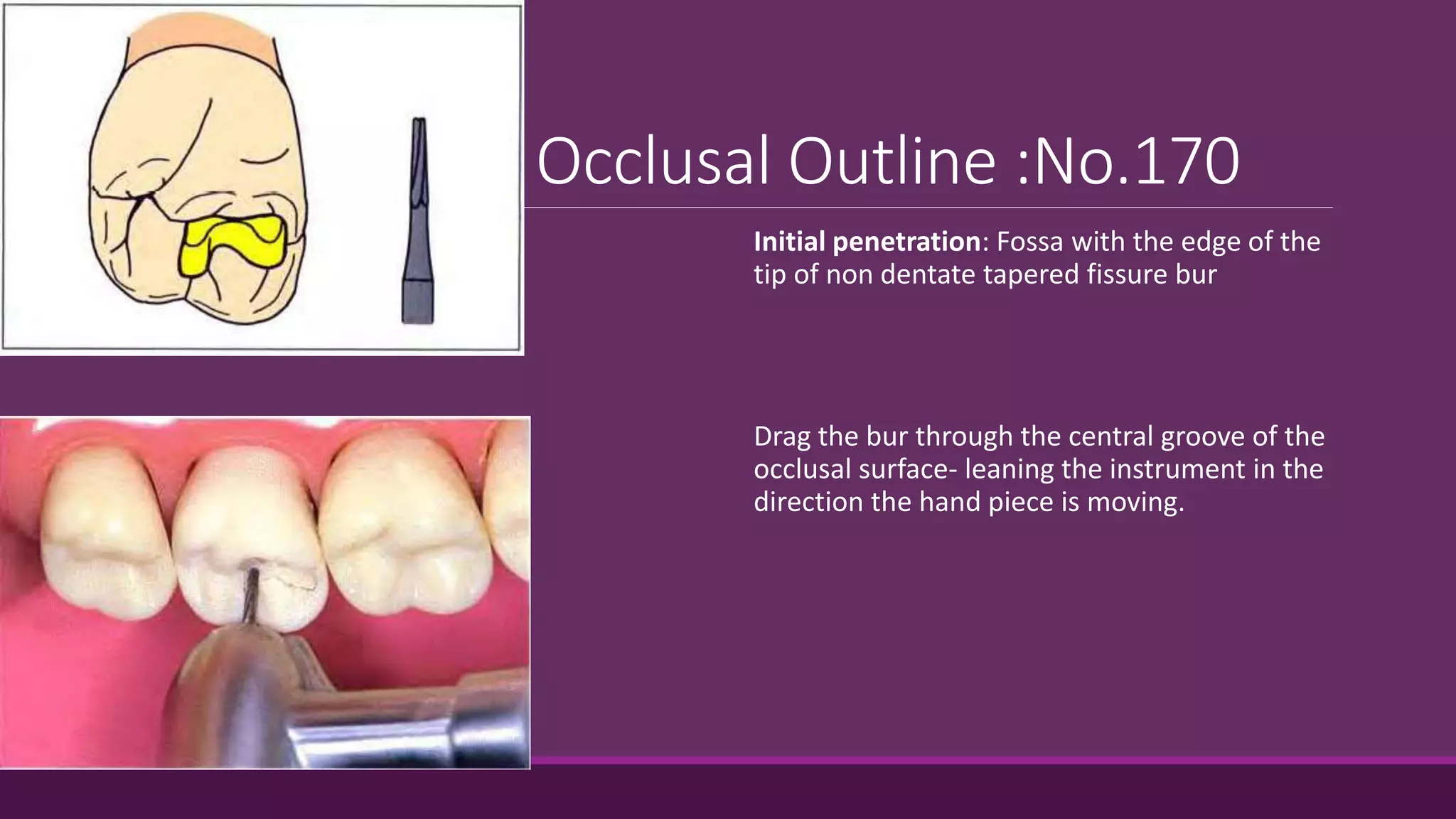 Class II Inlay | PPTX