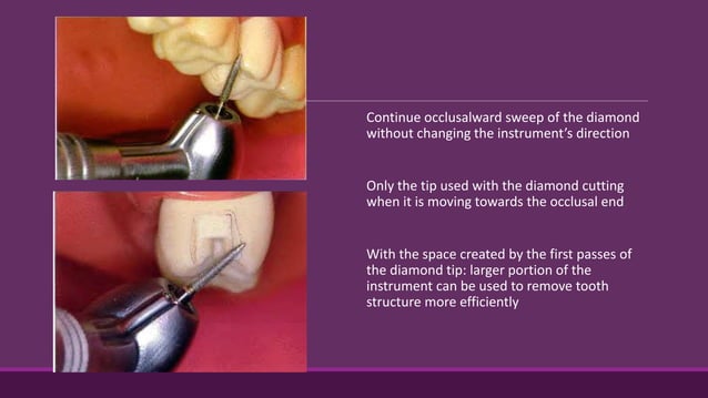 Class II Inlay | PPTX