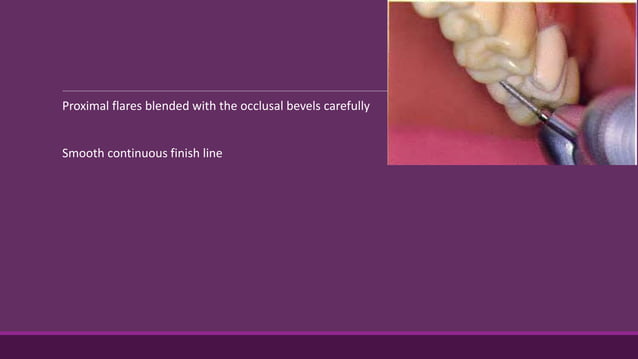 Class II Inlay | PPTX