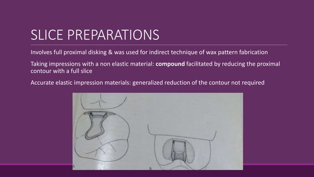Class II Inlay | PPTX