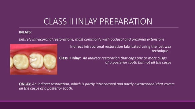Class II Inlay | PPTX