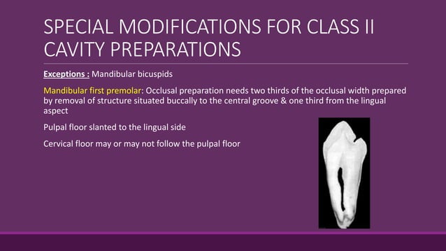 Class II Inlay | PPTX