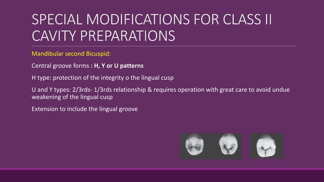 Class II Inlay | PPTX