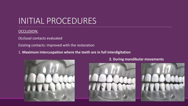 Class II Inlay | PPTX