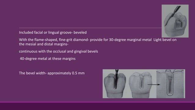 Class II Inlay | PPTX