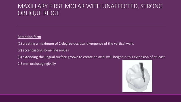 Class II Inlay | PPTX