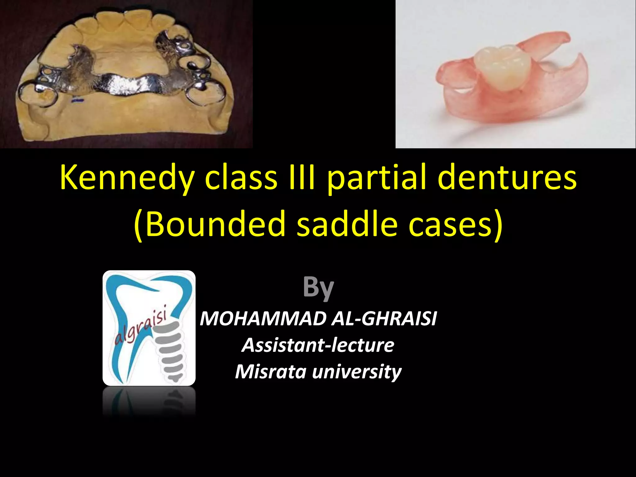 Class iii rpd | PPTX