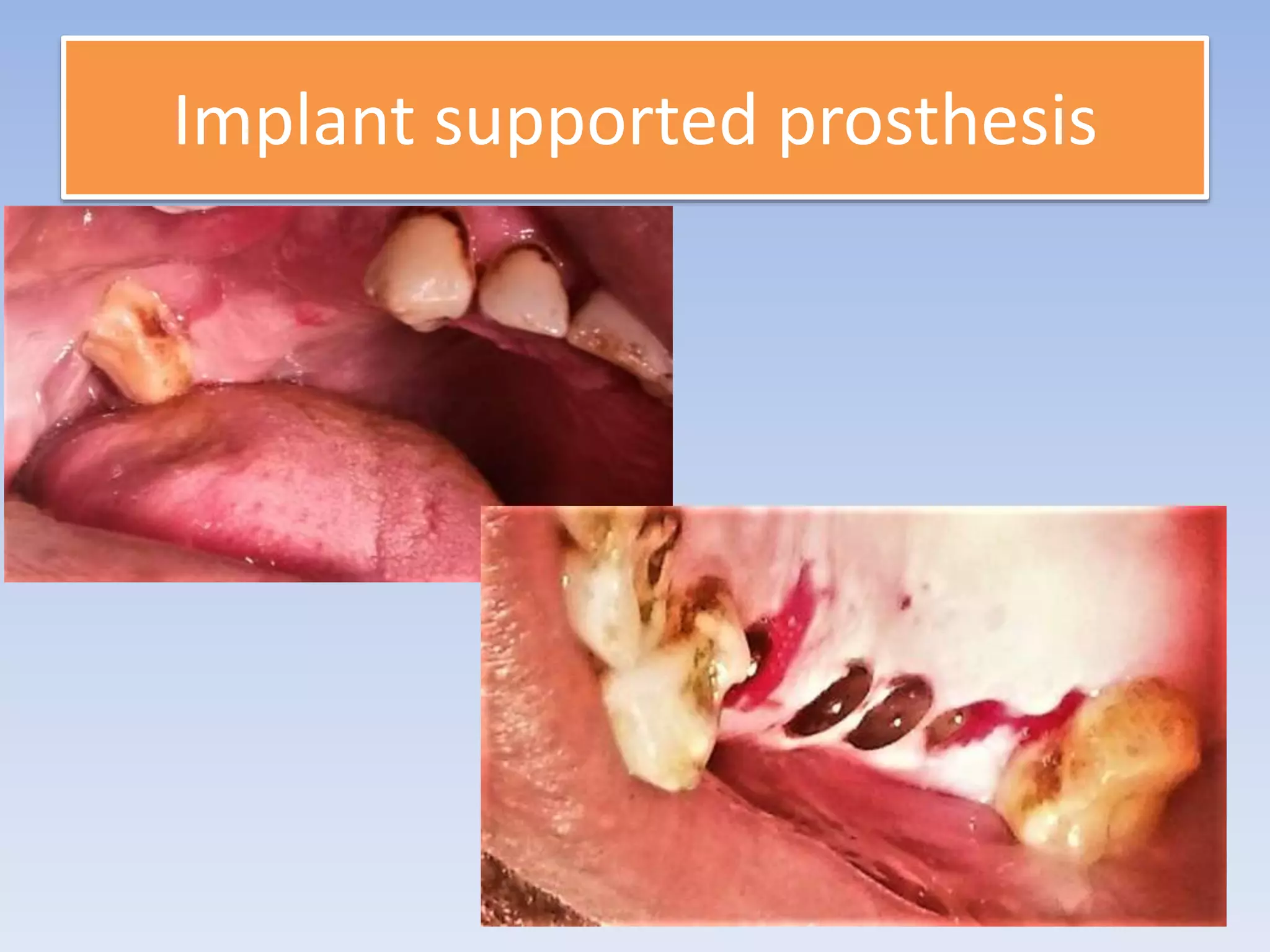 Class iii rpd | PPTX