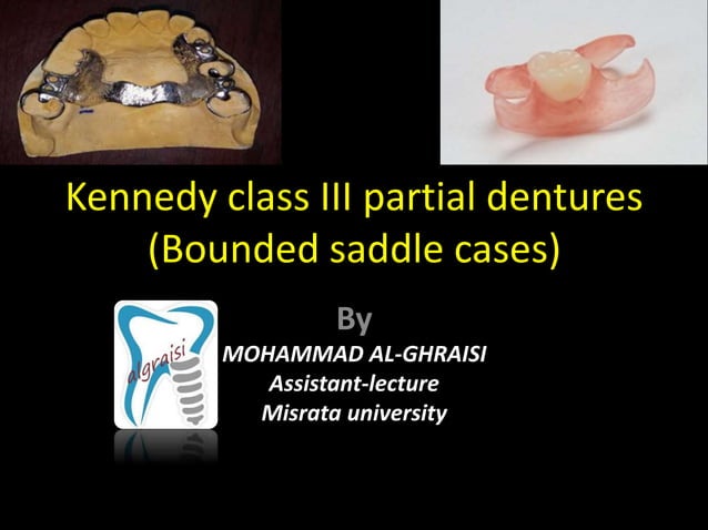 Class iii rpd | PPTX