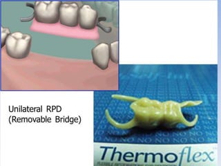 Class iii rpd | PPTX