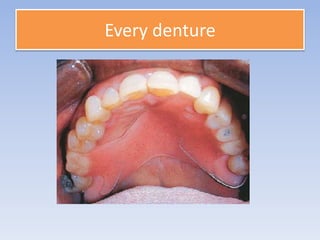 Class iii rpd | PPTX