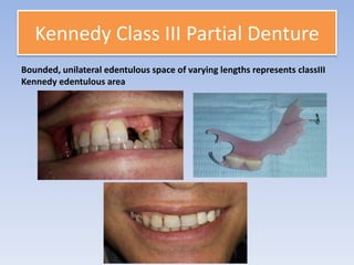 Class iii rpd | PPTX