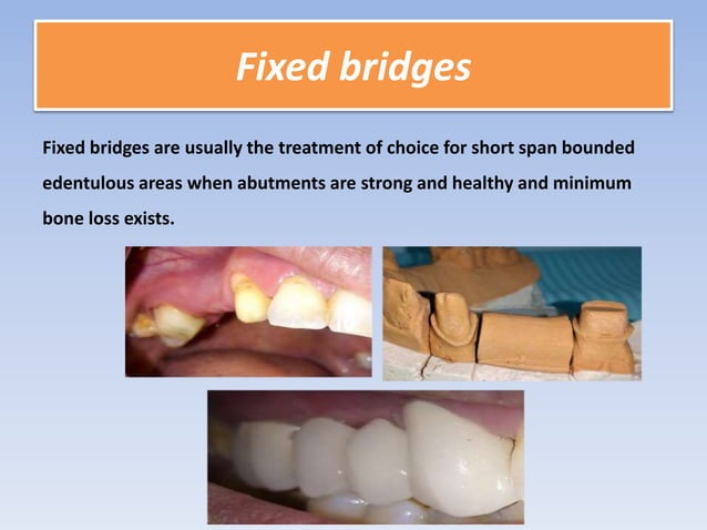 Class iii rpd | PPTX