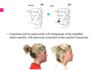 Class III treatment mbt | PPTX