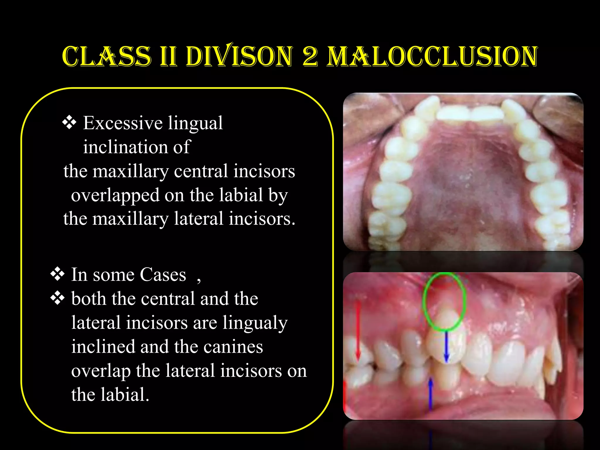 Class – II malocclusion | PPTX