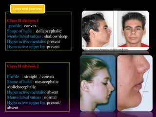 Class – II malocclusion | PPTX