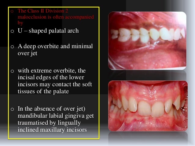 Skeletal Class Ii Malocclusion