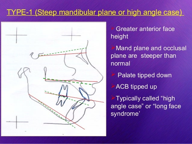 Class 2 malocclusion