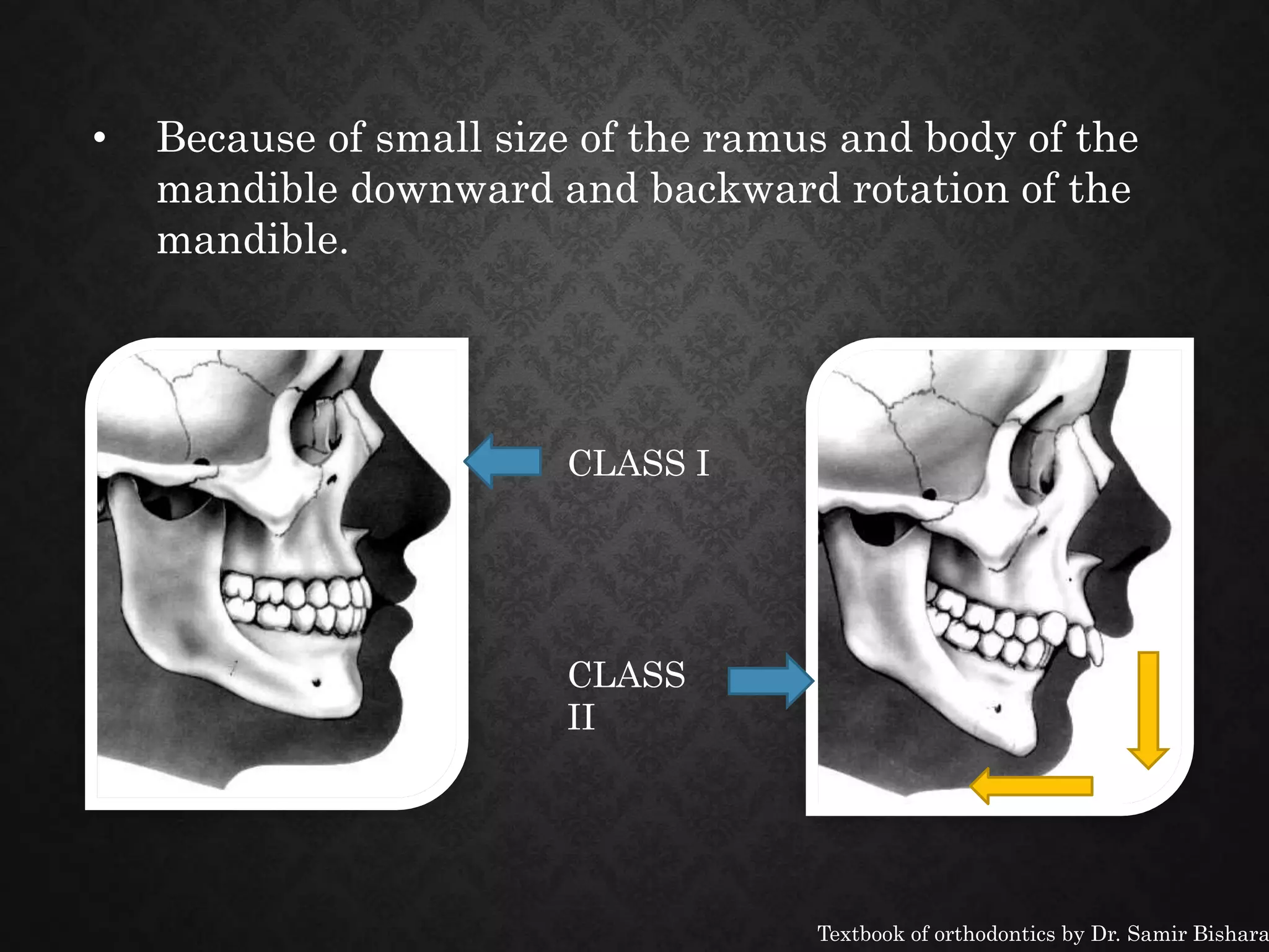 Class ii malocclusion | PPTX