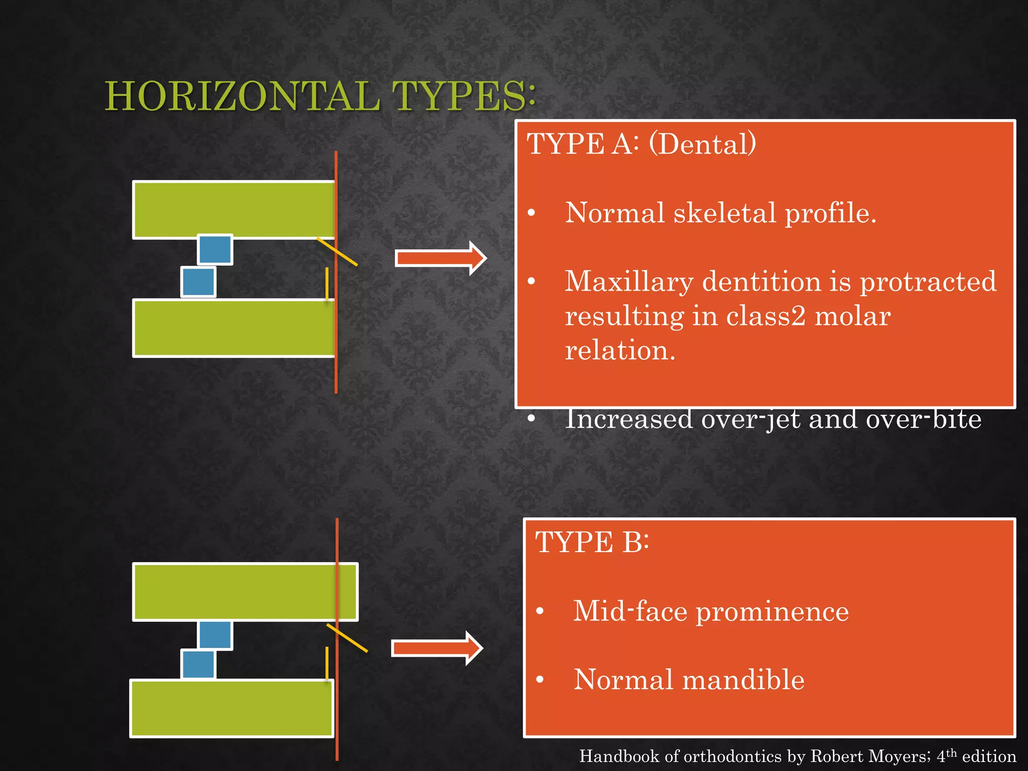 Class ii malocclusion | PPTX
