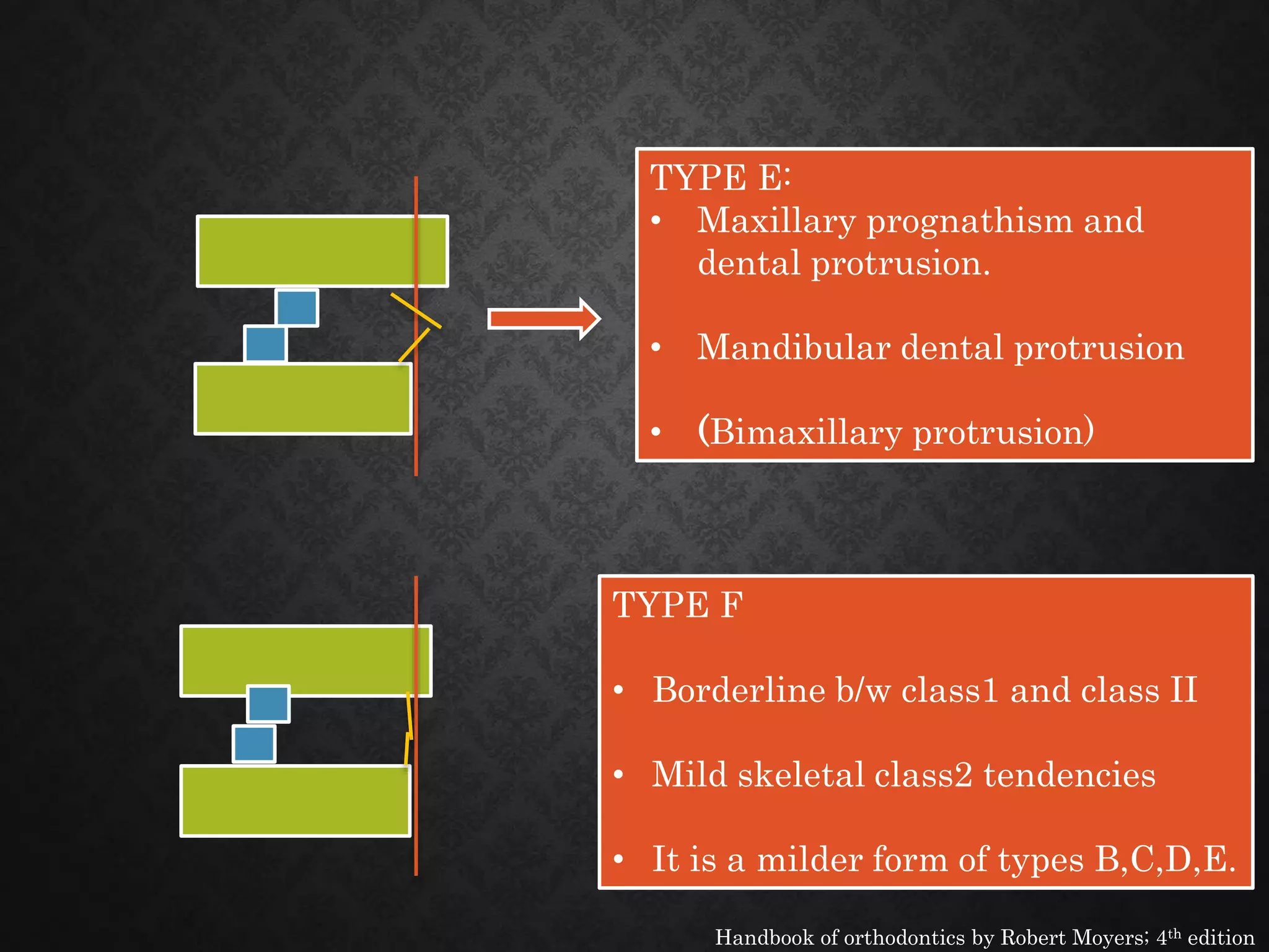 Class ii malocclusion | PPTX
