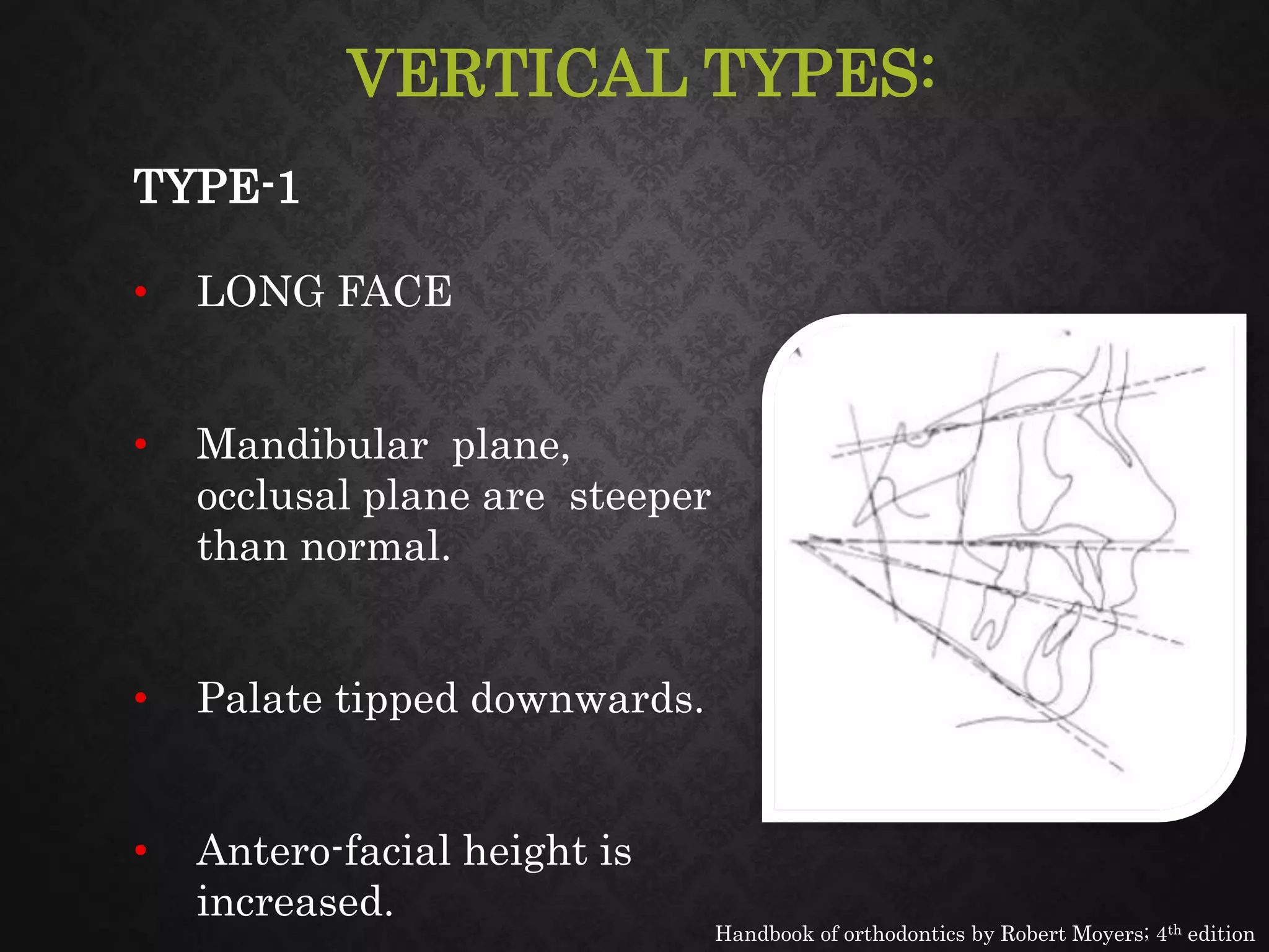 Class ii malocclusion | PPTX