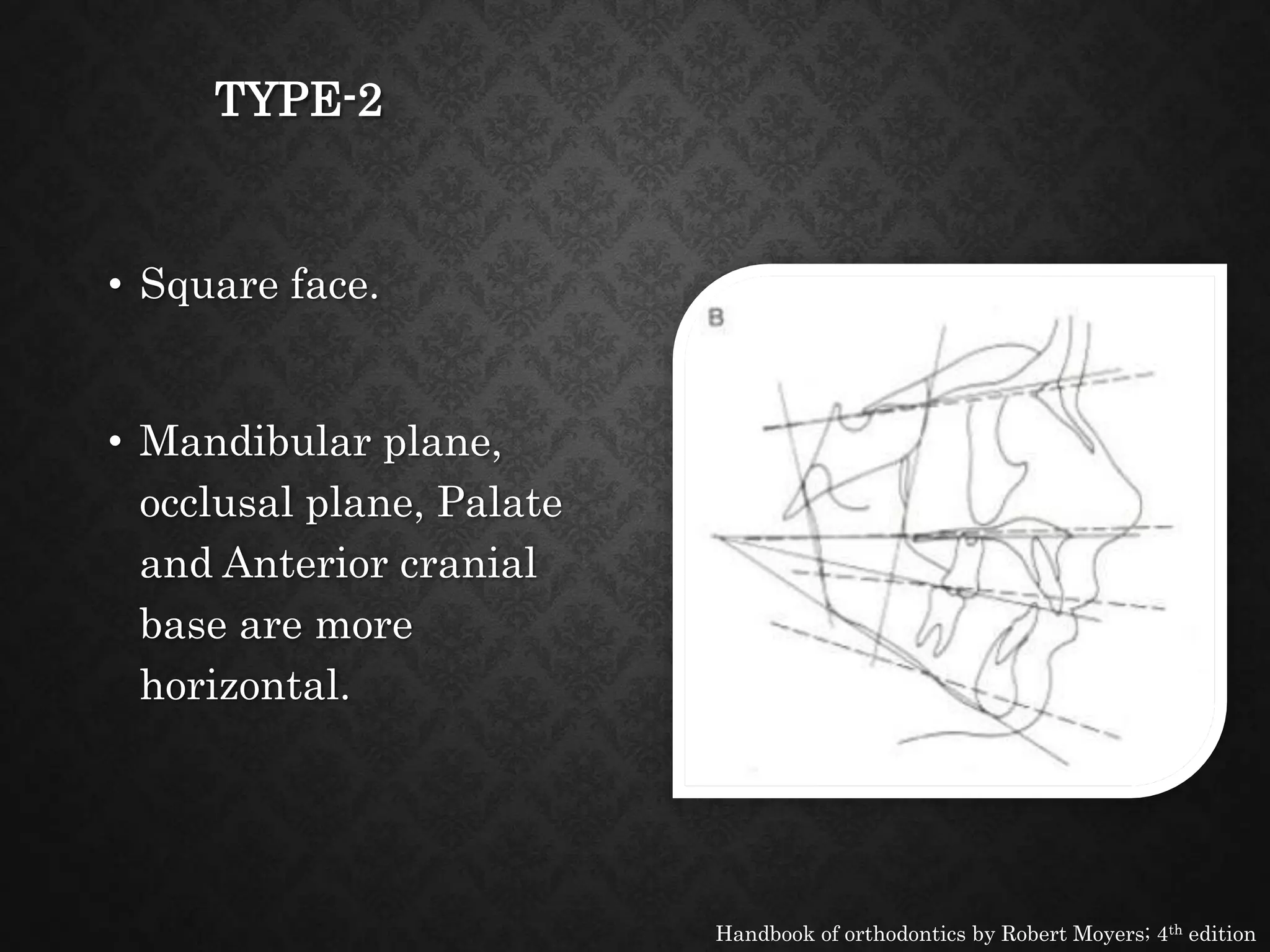 Class ii malocclusion | PPTX