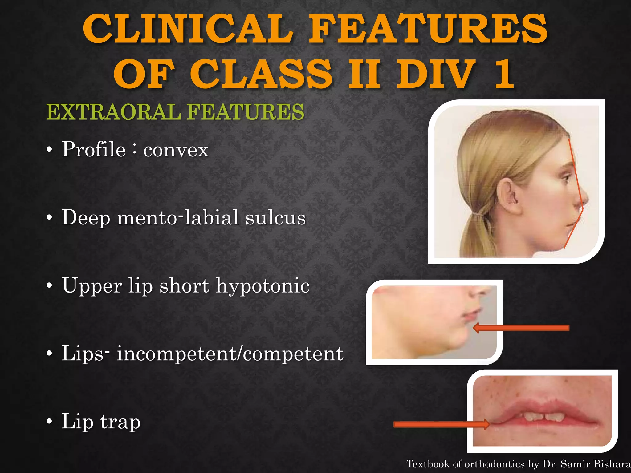 Class ii malocclusion | PPTX