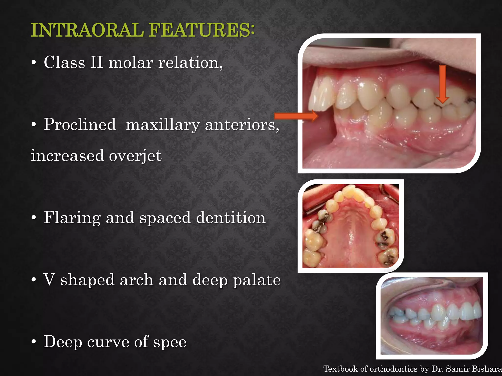 Class ii malocclusion | PPTX
