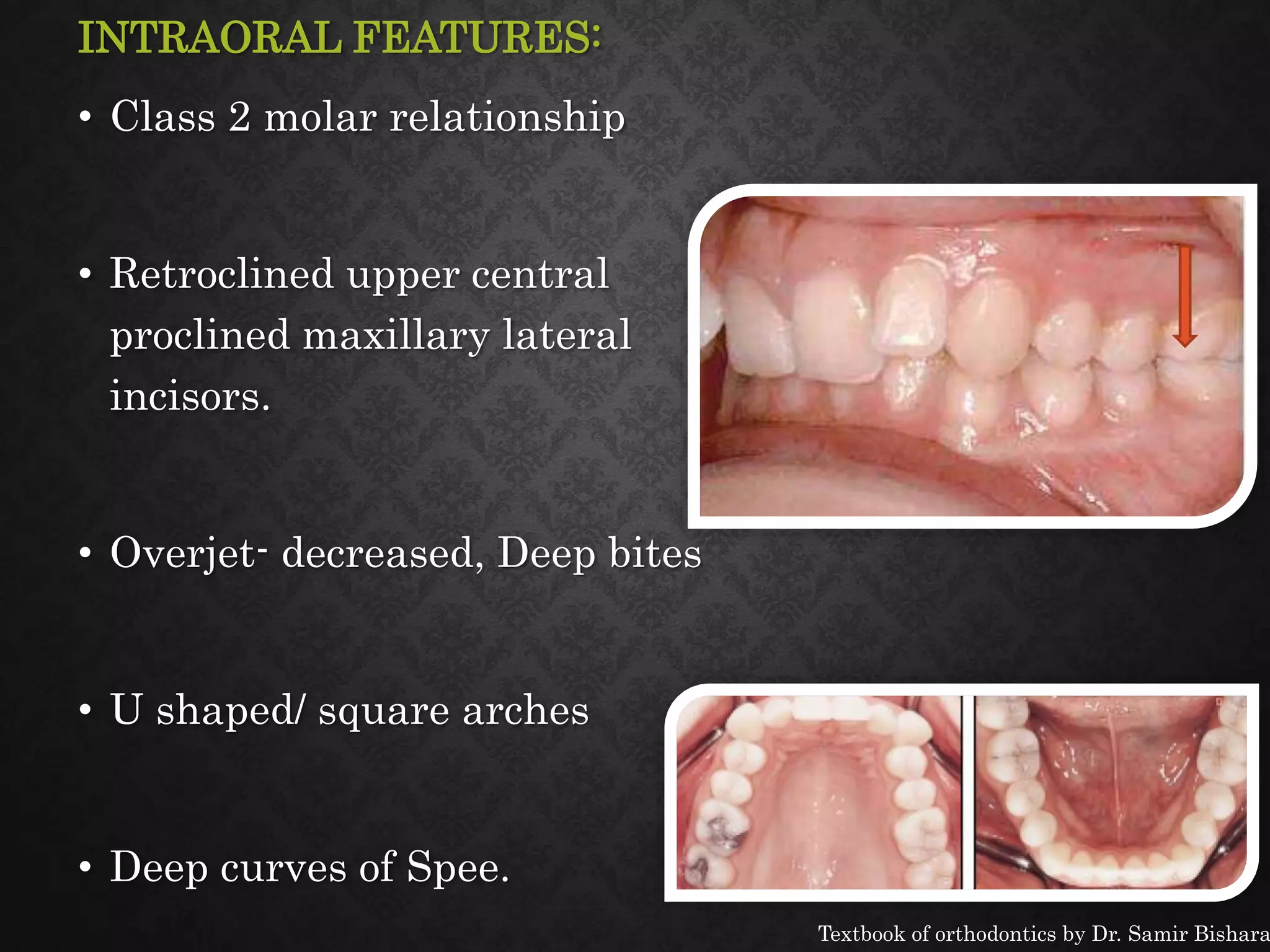 Class ii malocclusion | PPTX