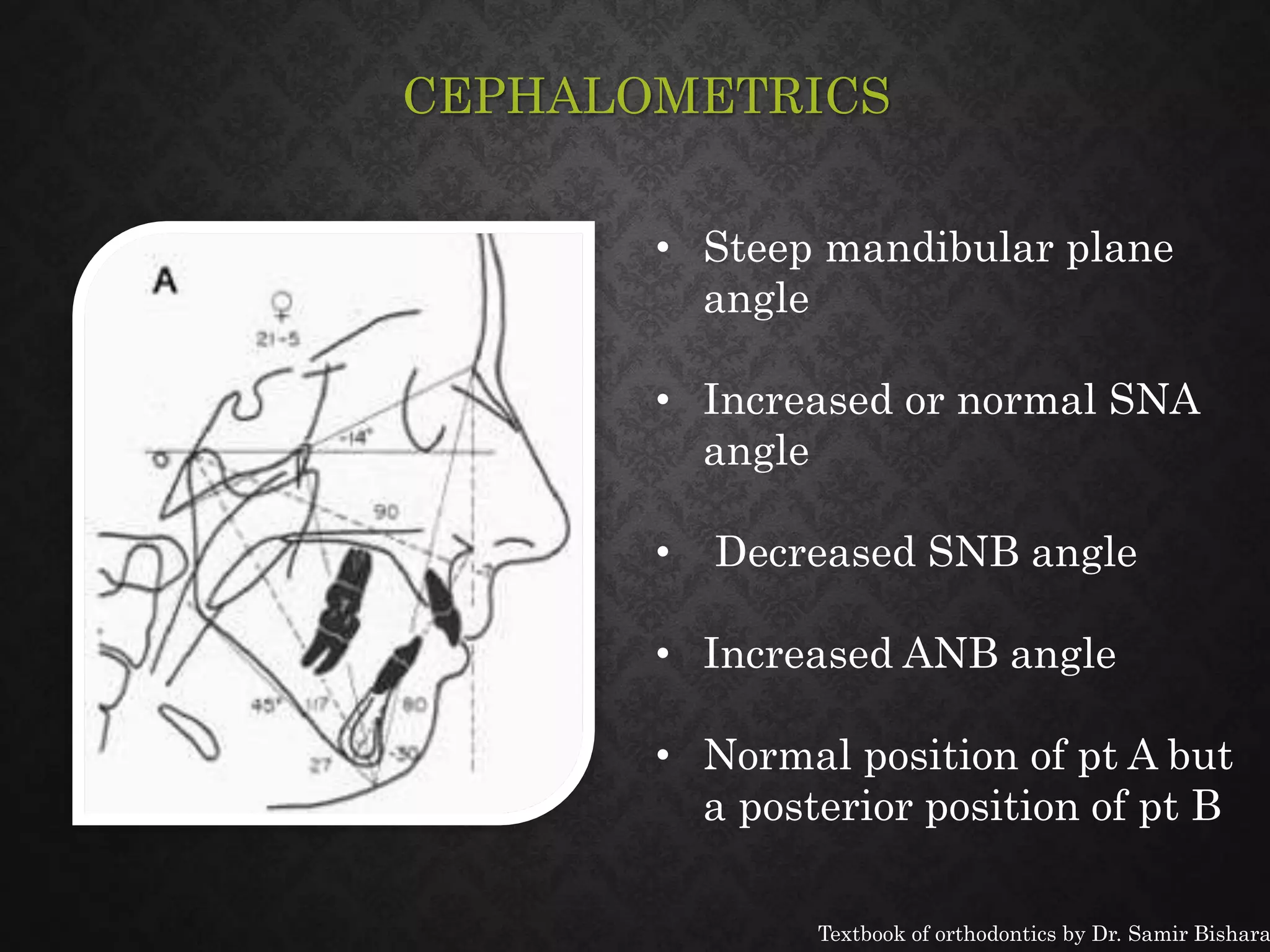 Class ii malocclusion | PPTX