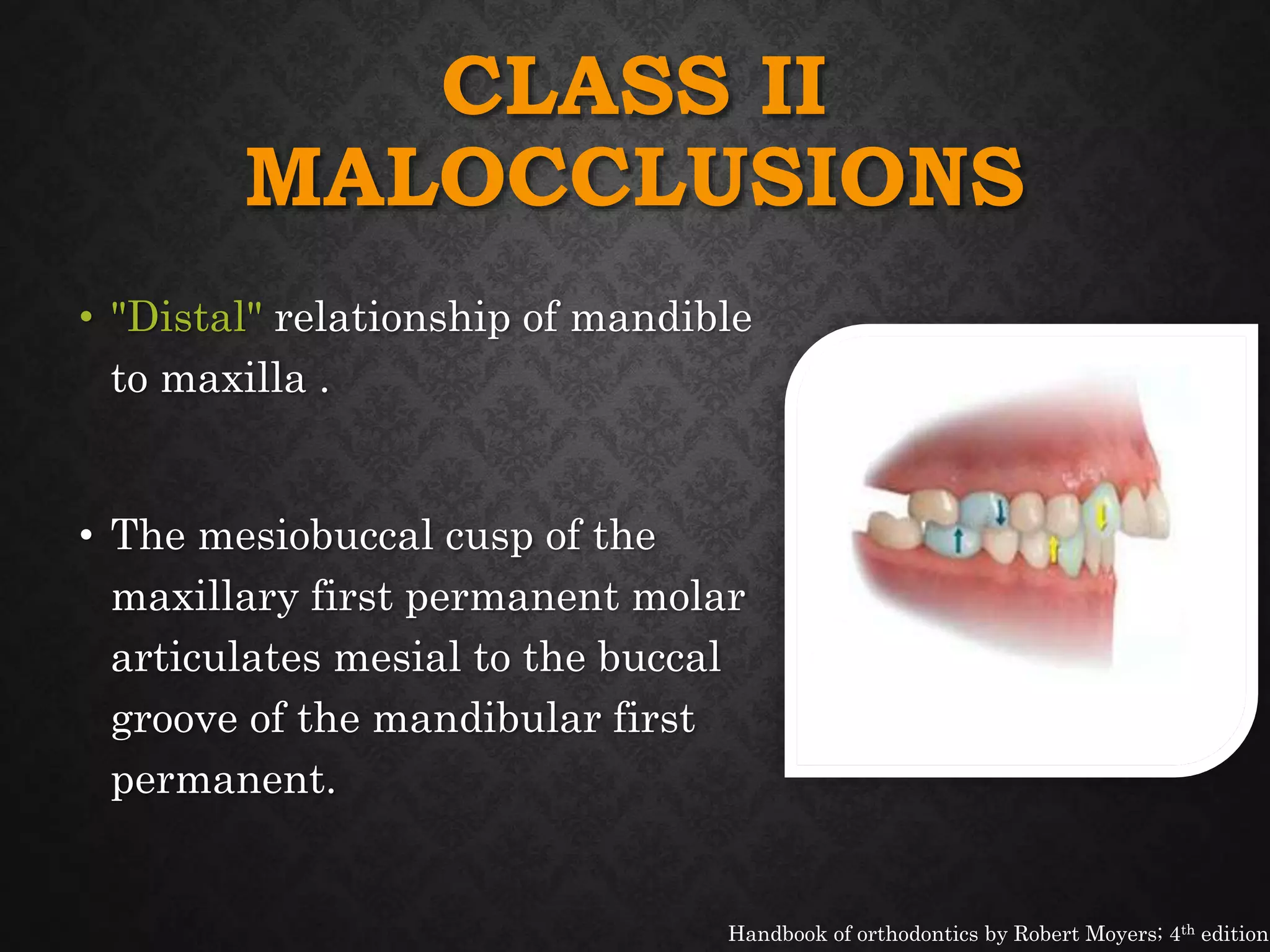 Class ii malocclusion | PPTX