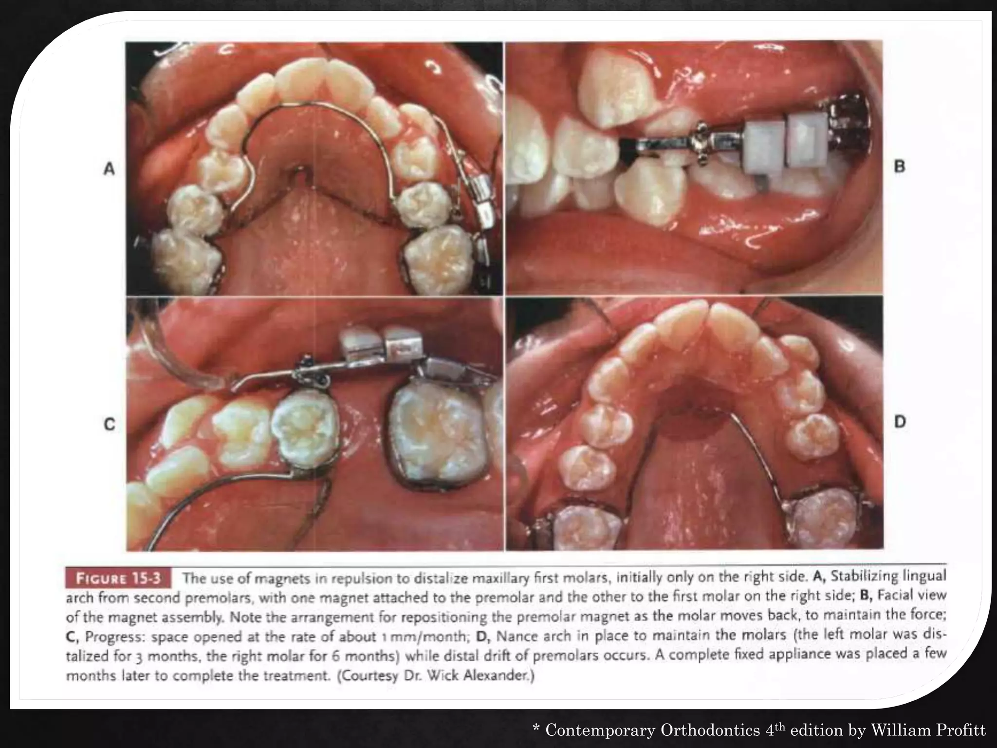 Class ii malocclusion | PPTX