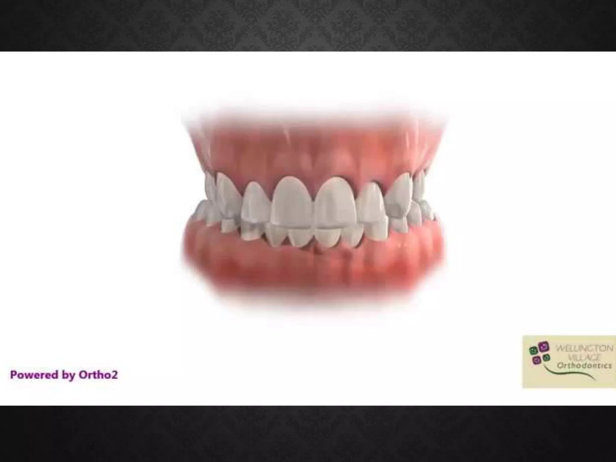 Class ii malocclusion | PPTX