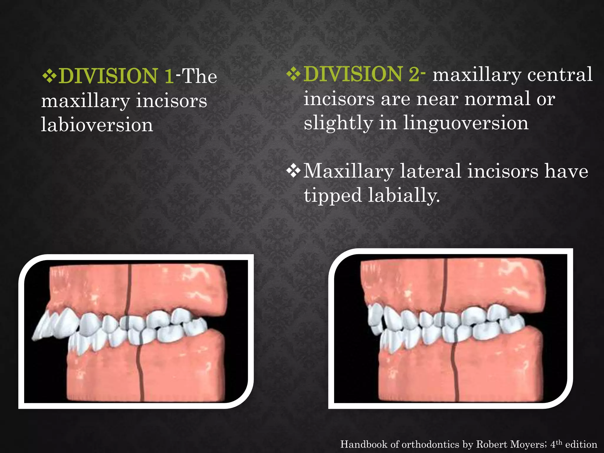 Class ii malocclusion | PPTX