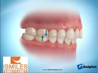 Class ii malocclusion | PPTX