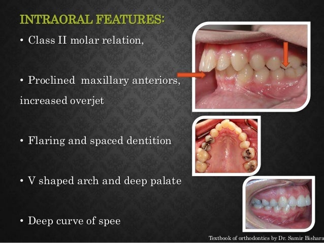Class ii malocclusion