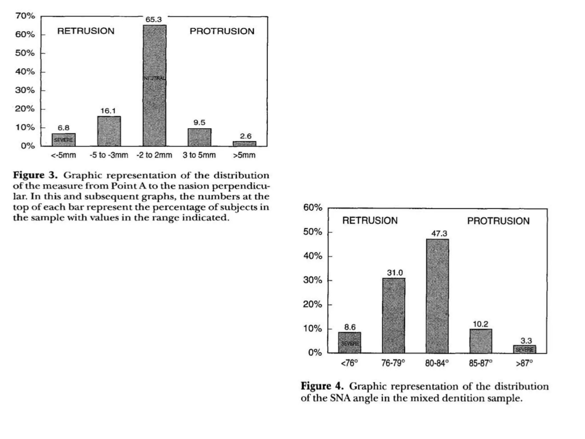 CLASS II MALOCCLUSION diagnosis and treatment.ppt