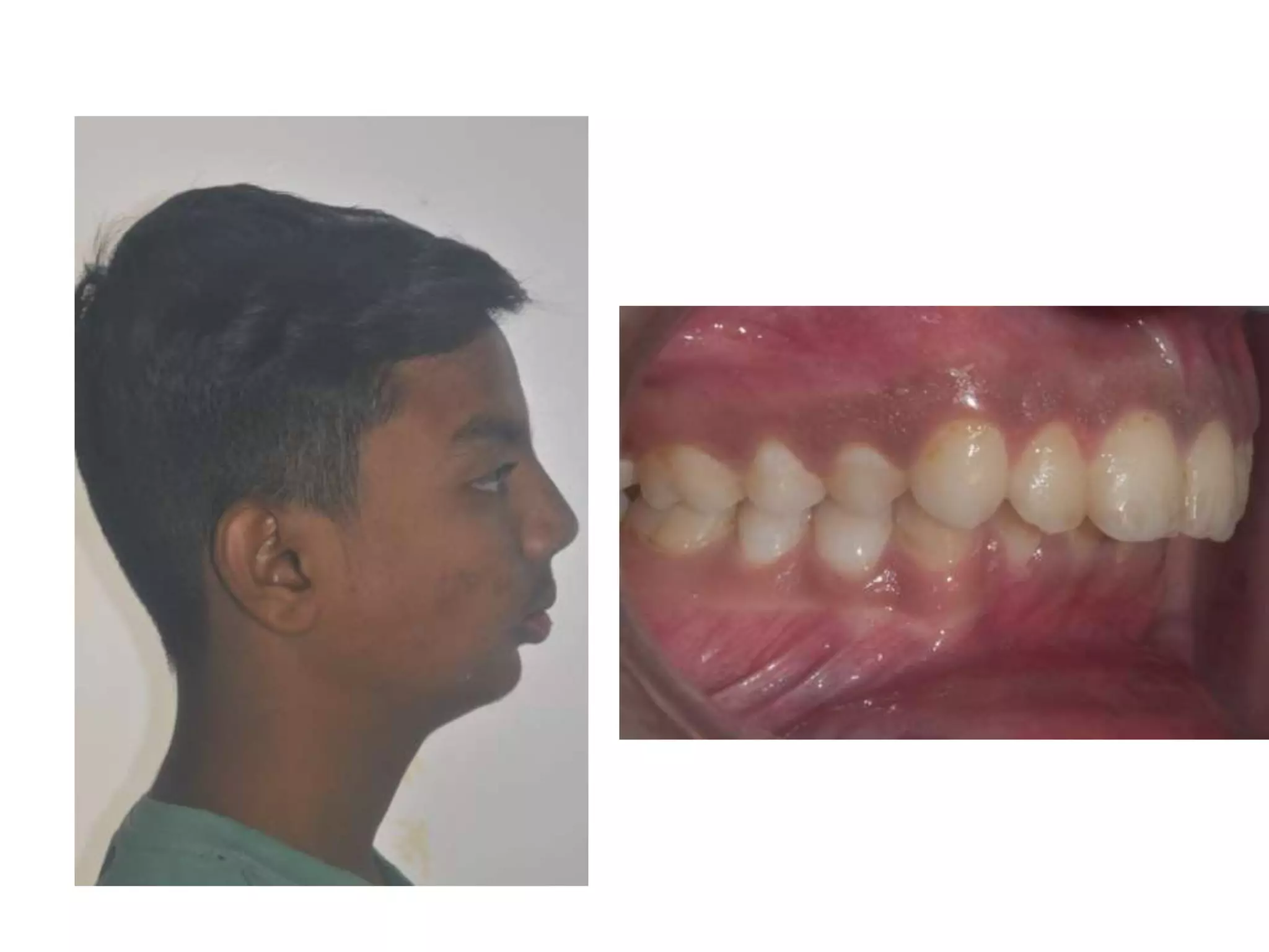 CLASS II MALOCCLUSION diagnosis and treatment.ppt