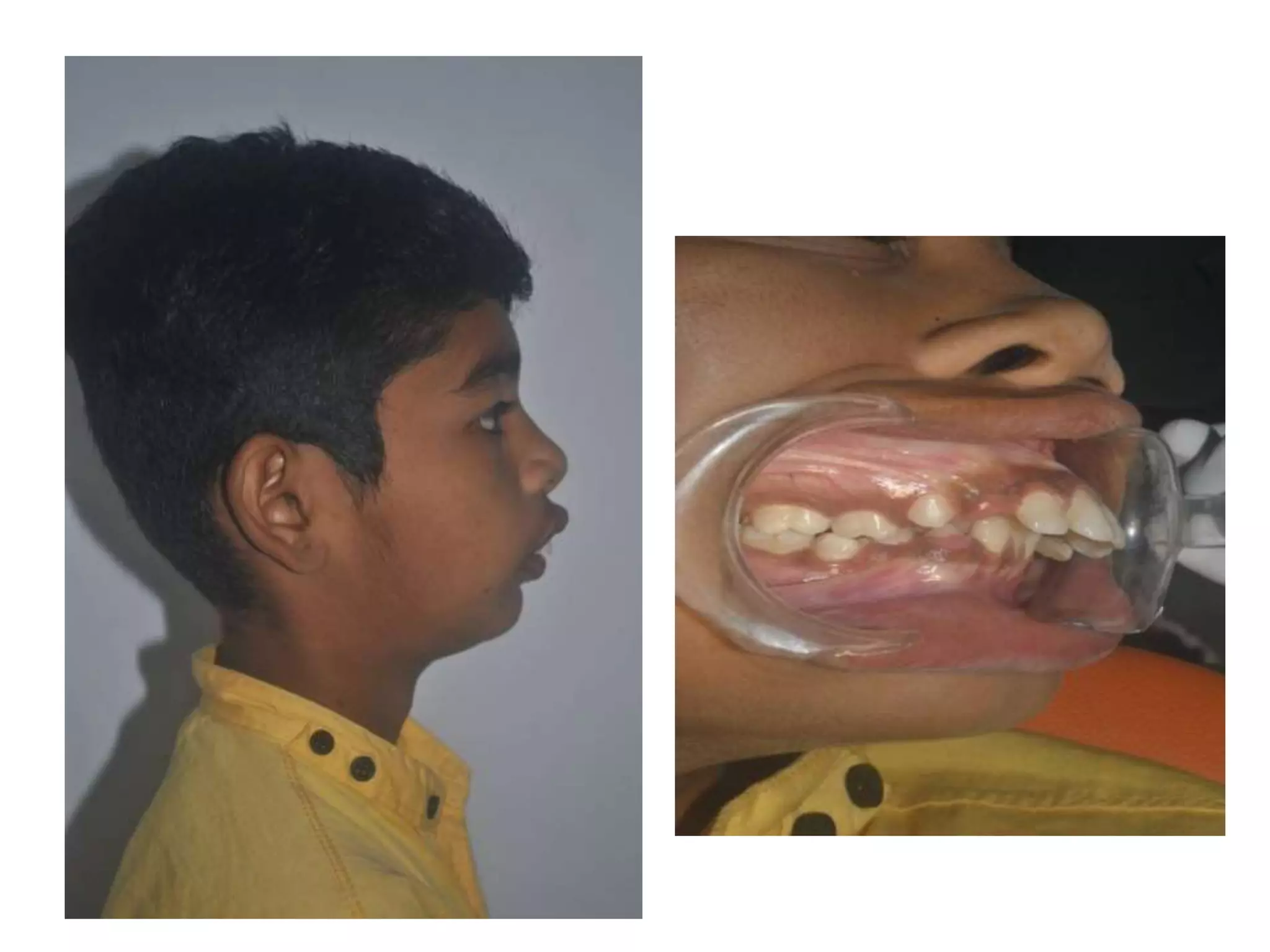 CLASS II MALOCCLUSION diagnosis and treatment.ppt