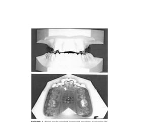 CLASS II MALOCCLUSION diagnosis and treatment.ppt