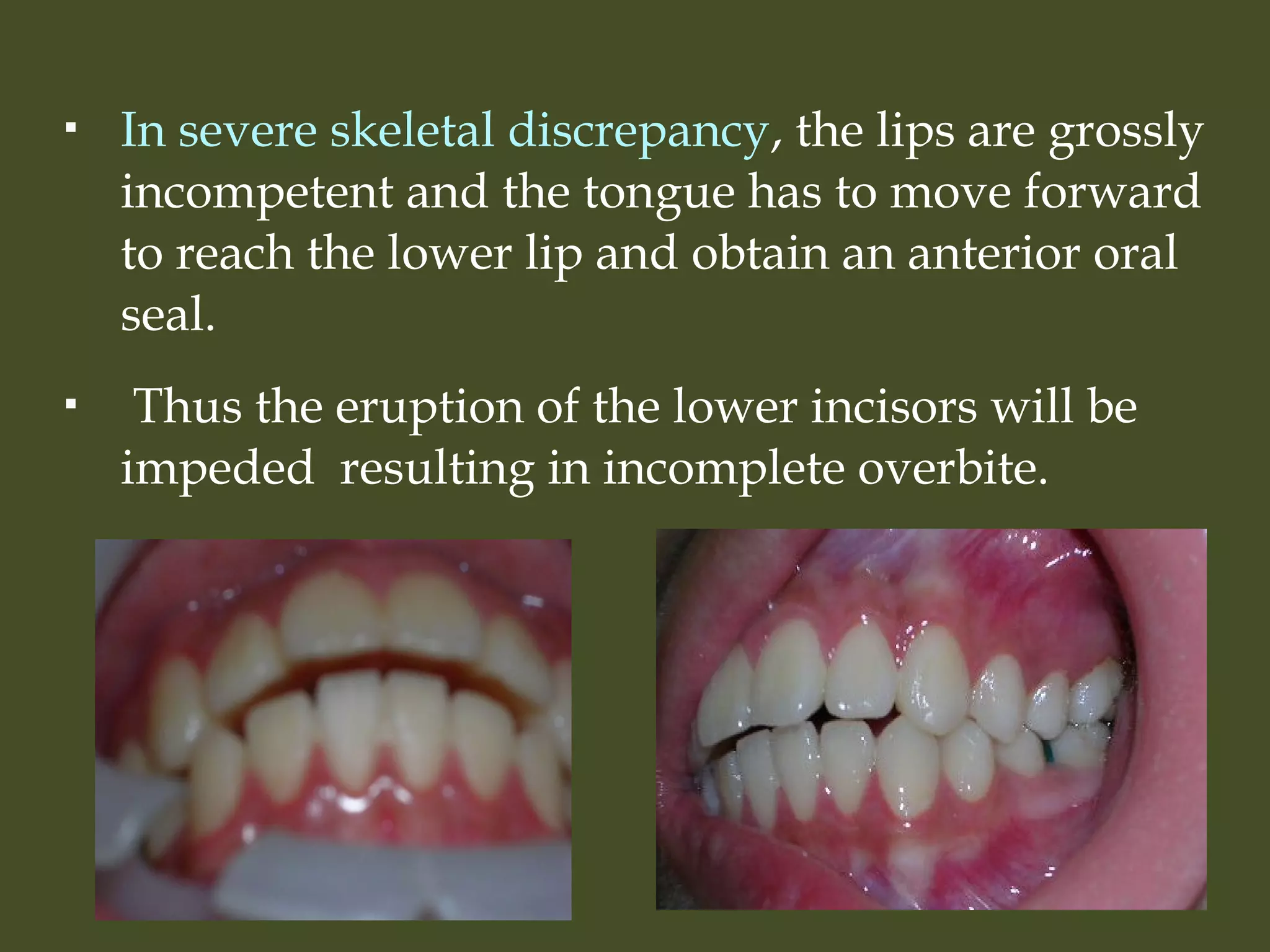 Class II malocclusion | PPT