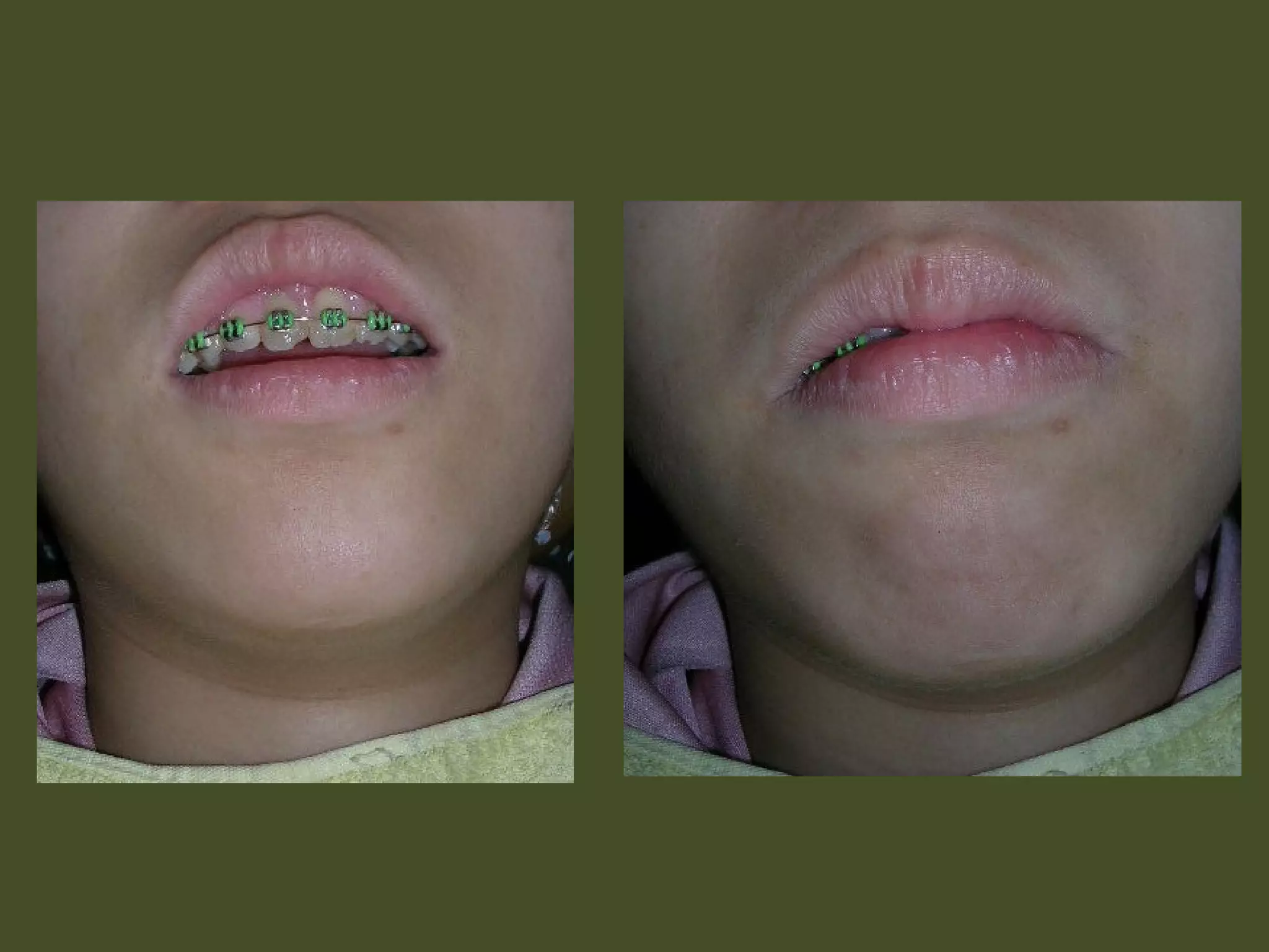 Class II malocclusion | PPT
