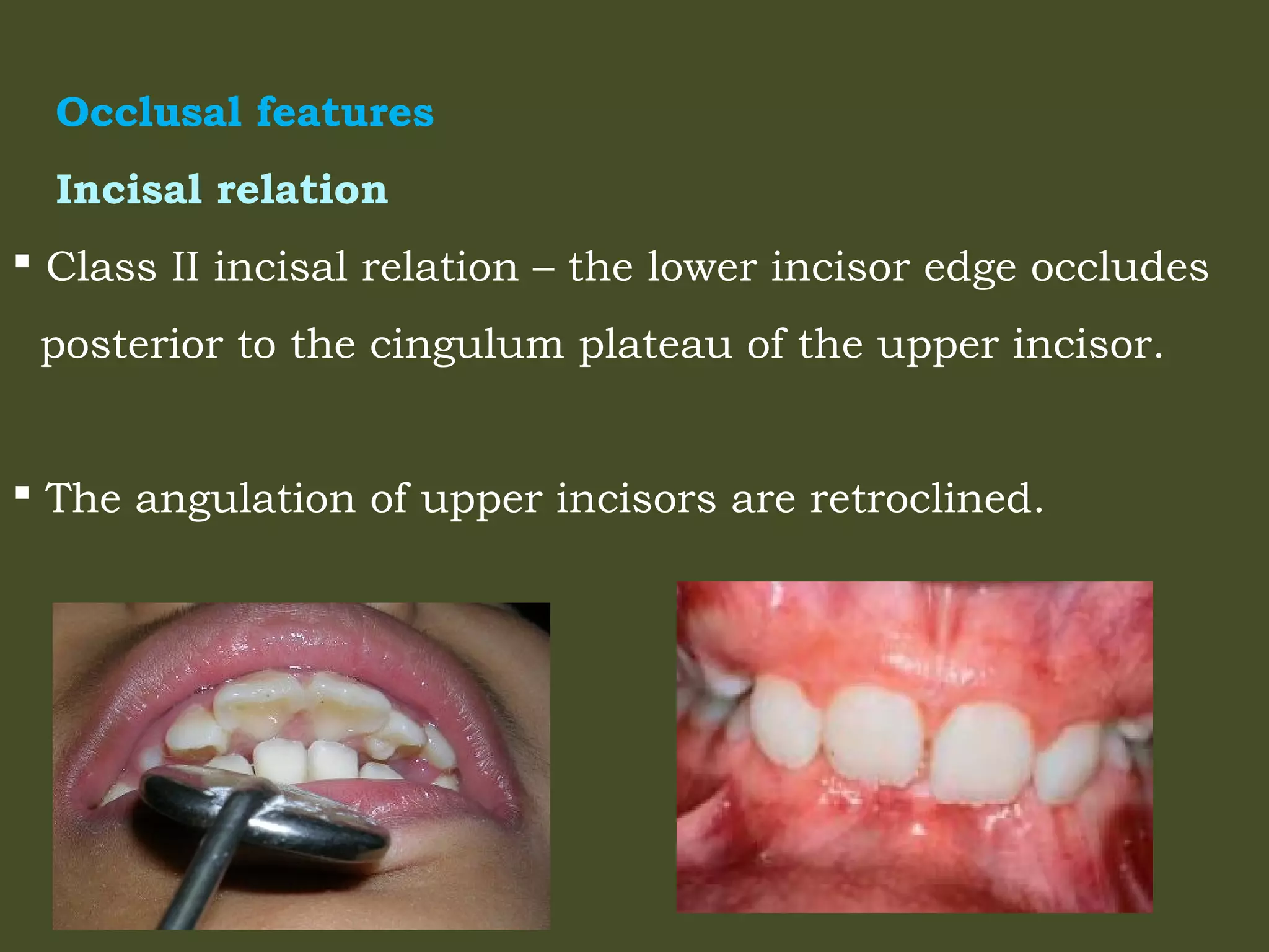 Class II malocclusion | PPT