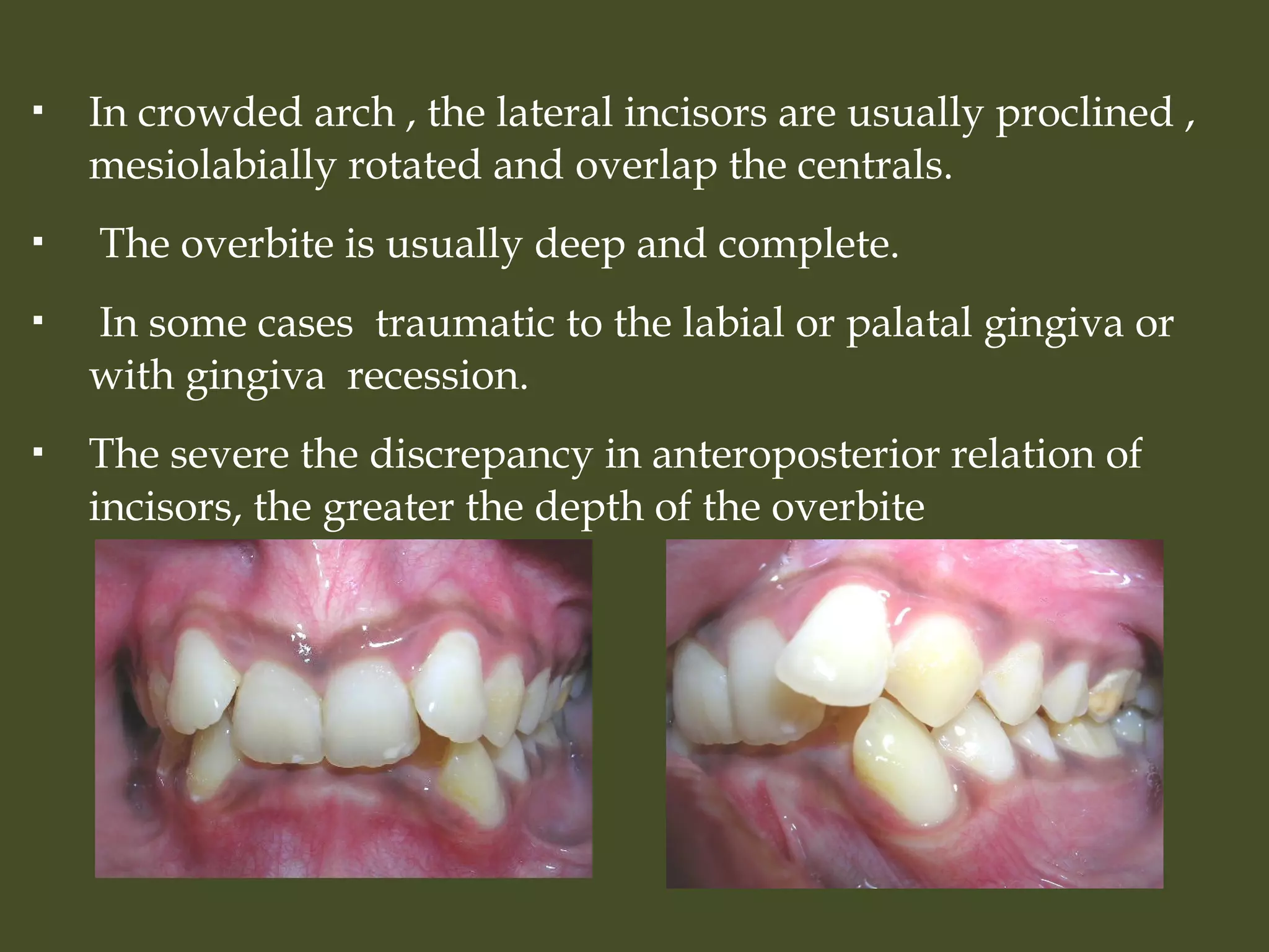 Class II malocclusion | PPT