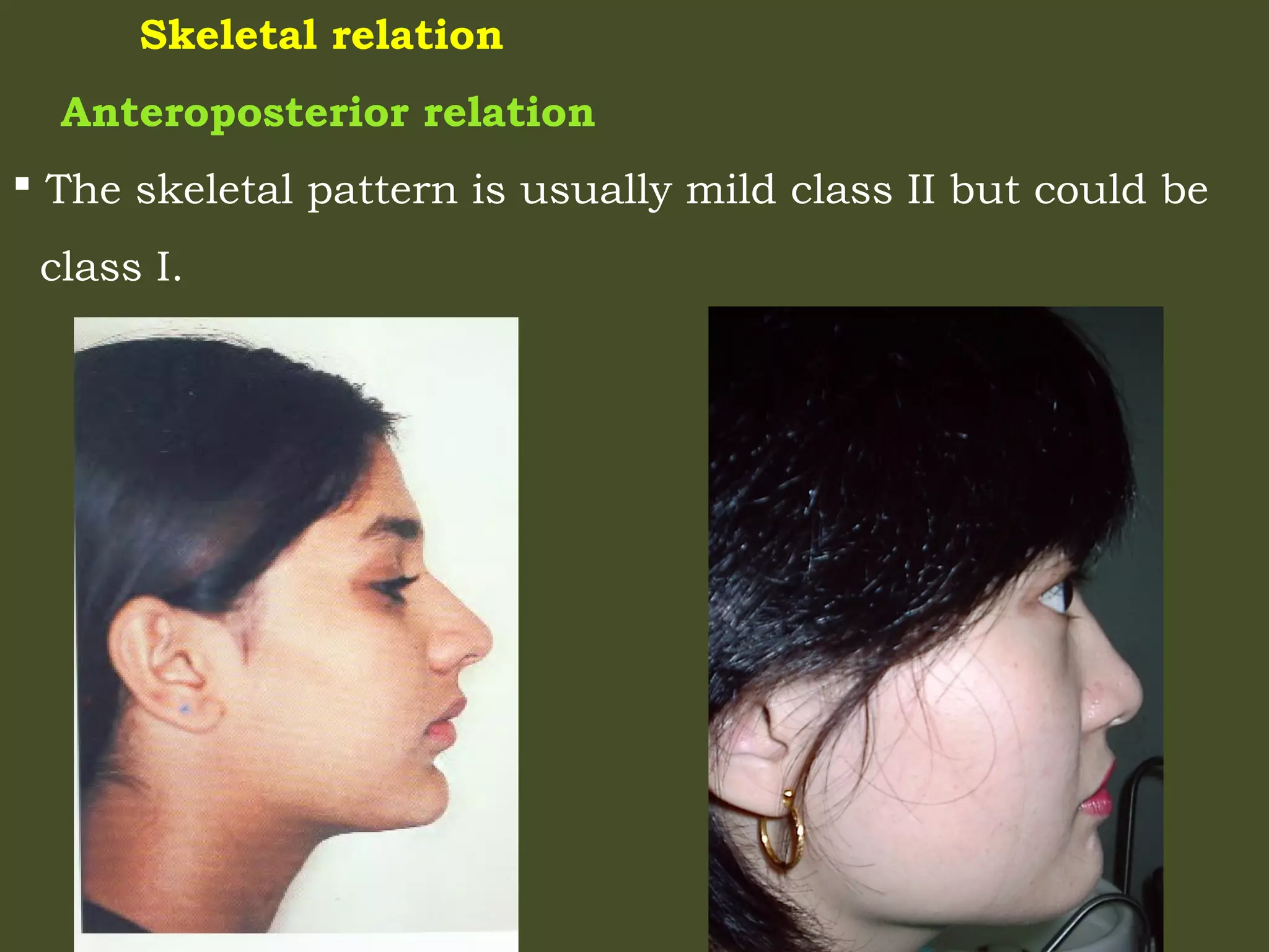 Class II malocclusion | PPT