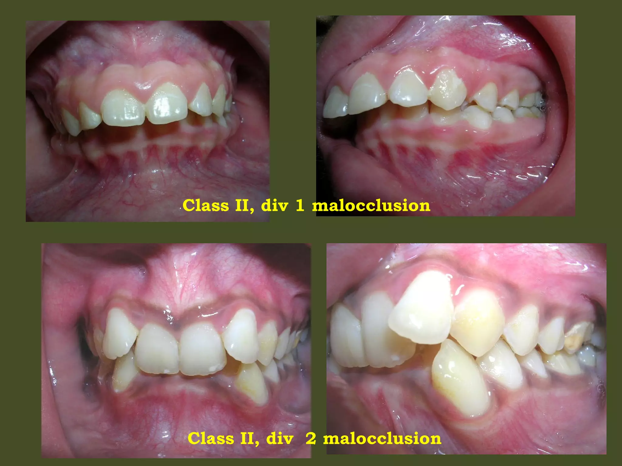 Class II malocclusion | PPT