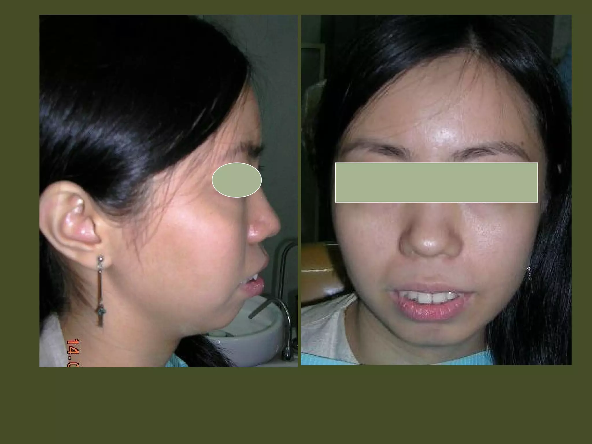 Class II malocclusion | PPT
