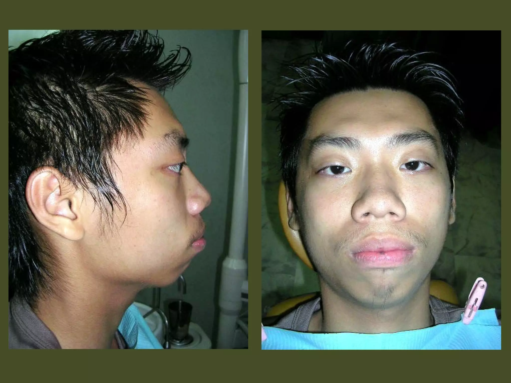 Class Ii Malocclusion Ppt